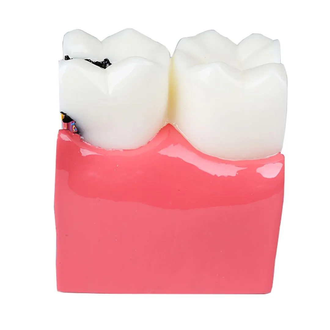 iDENTical Caries V/S Healthy Teeth Model M4021 Online at Best Price ...