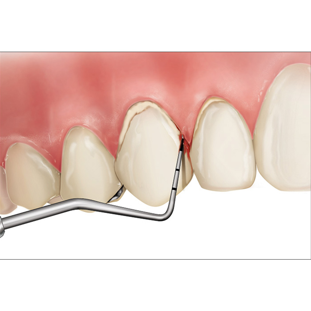 Periodontal Probe Canine