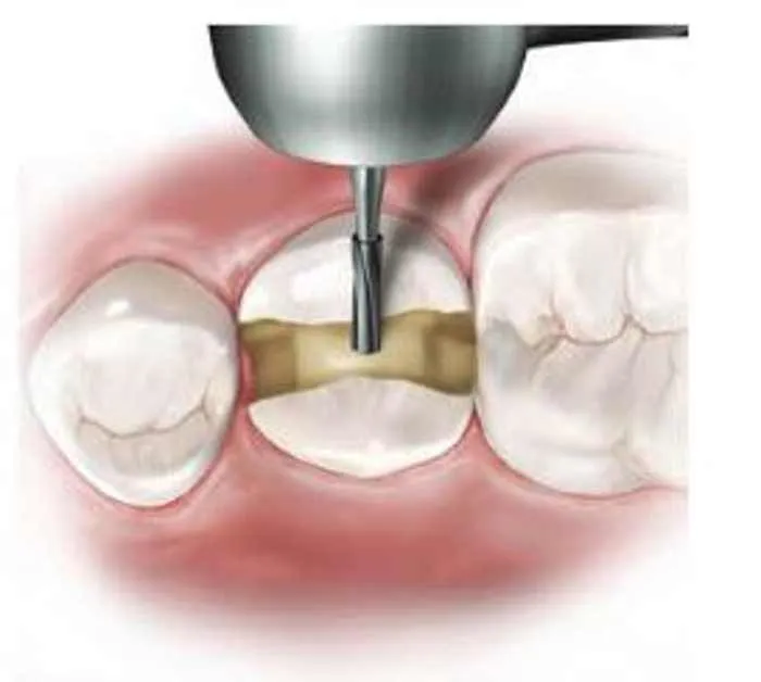 Ss White Surgical Length Carbide Fg Burs Online at Best Price ...