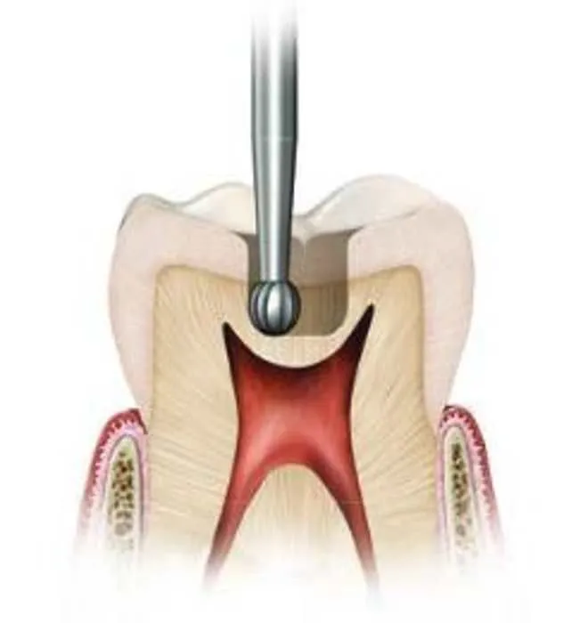 Buy Surgical Burs for Straight Handpiece with Dental Surgical Bur ...